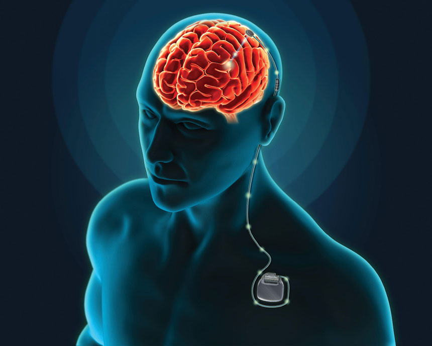 New Brain Stimulation Technique Shows Promise in Obesity Treatment ...